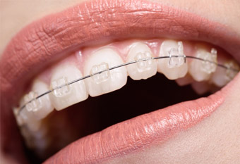 Ortodoncia :: Sonrisas Uruguay